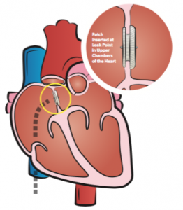 ASD/PFO Closure - Arkansas Heart Hospital