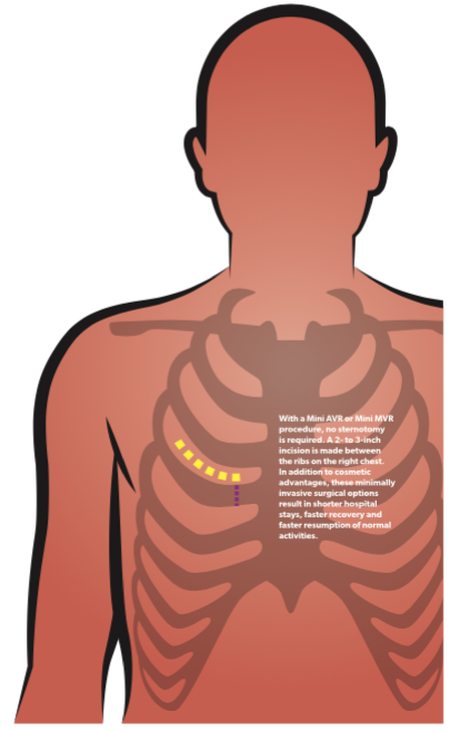 Mini AVR & Mini MVR - Arkansas Heart Hospital