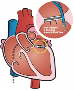 Paravalvular Leak Closure - Arkansas Heart Hospital