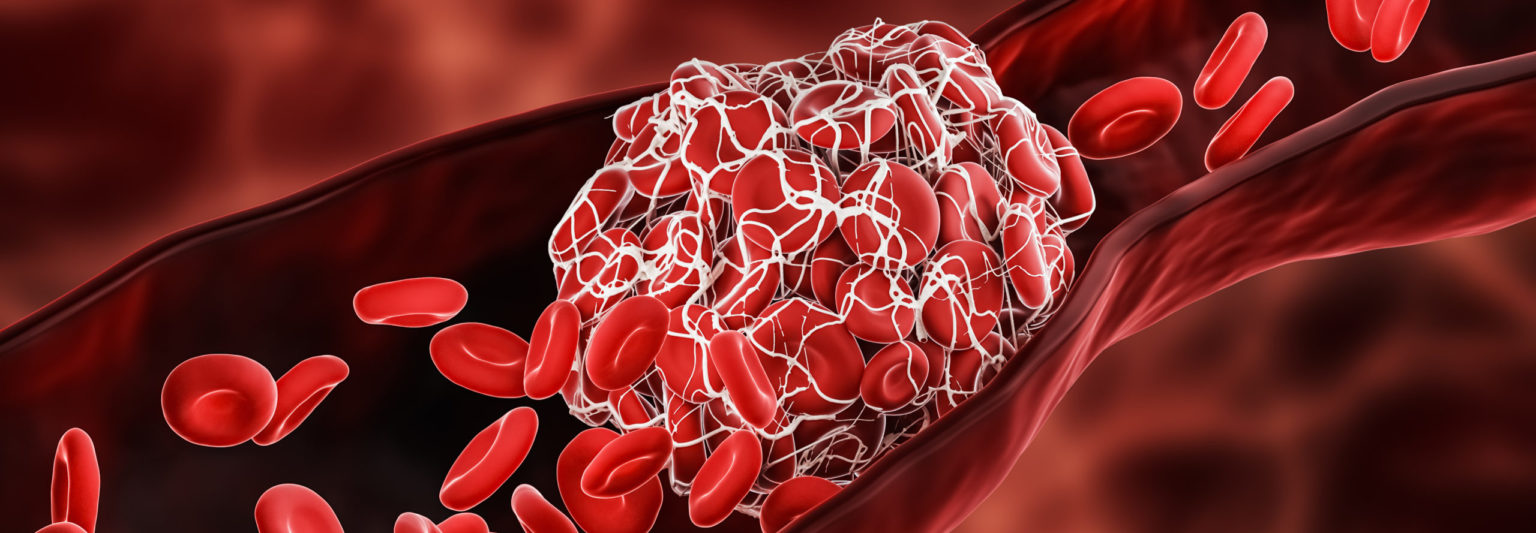 What Are Blood Clots? | Arkansas Heart Hospital