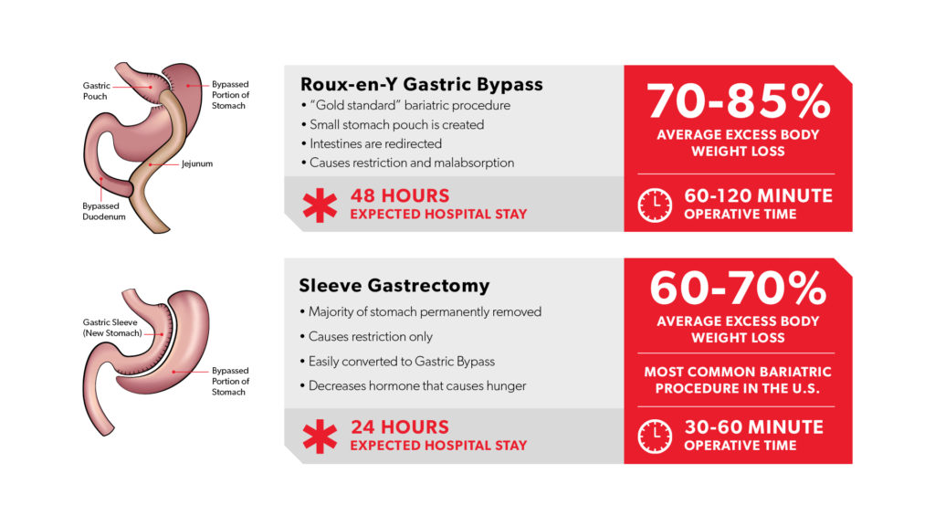Bariatric Surgery: What Are My Options? - Arkansas Heart Hospital